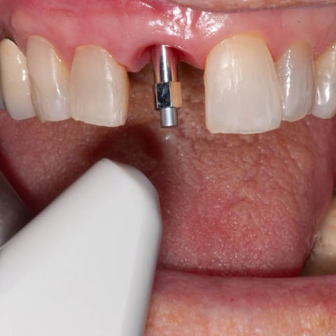 NeoTell™ - Know your implant stability in seconds