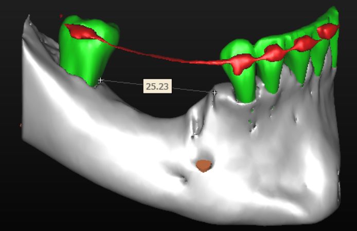 Clinical case - Vertical ridge augmentation